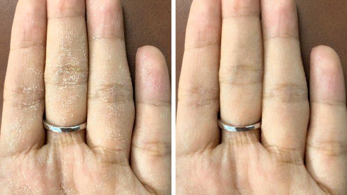 5 Rutinitas Perawatan Kulit untuk Tangan yang Kering Sampai Mengelupas ...