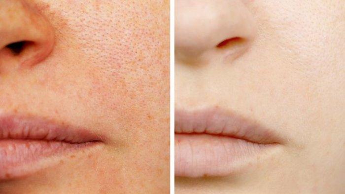 10 Tips Mudah Mengecilkan Pori-pori Besar di Wajahmu, Salah Satunya ...