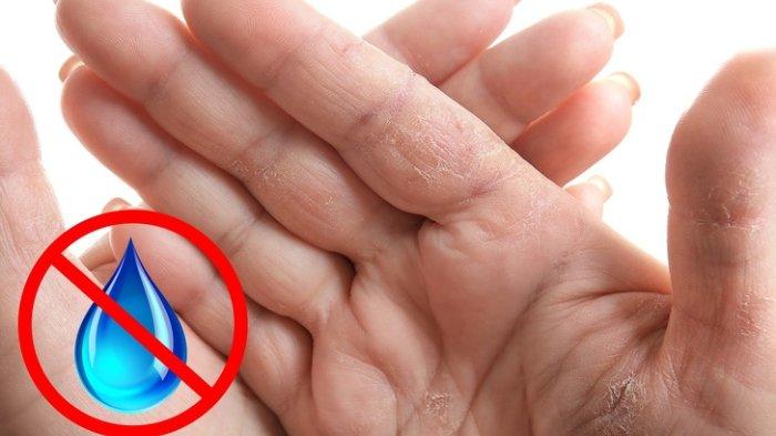 7 Kondisi Tangan Ini Ternyata Bisa Menunjukkan Masalah Kesehatanmu ...