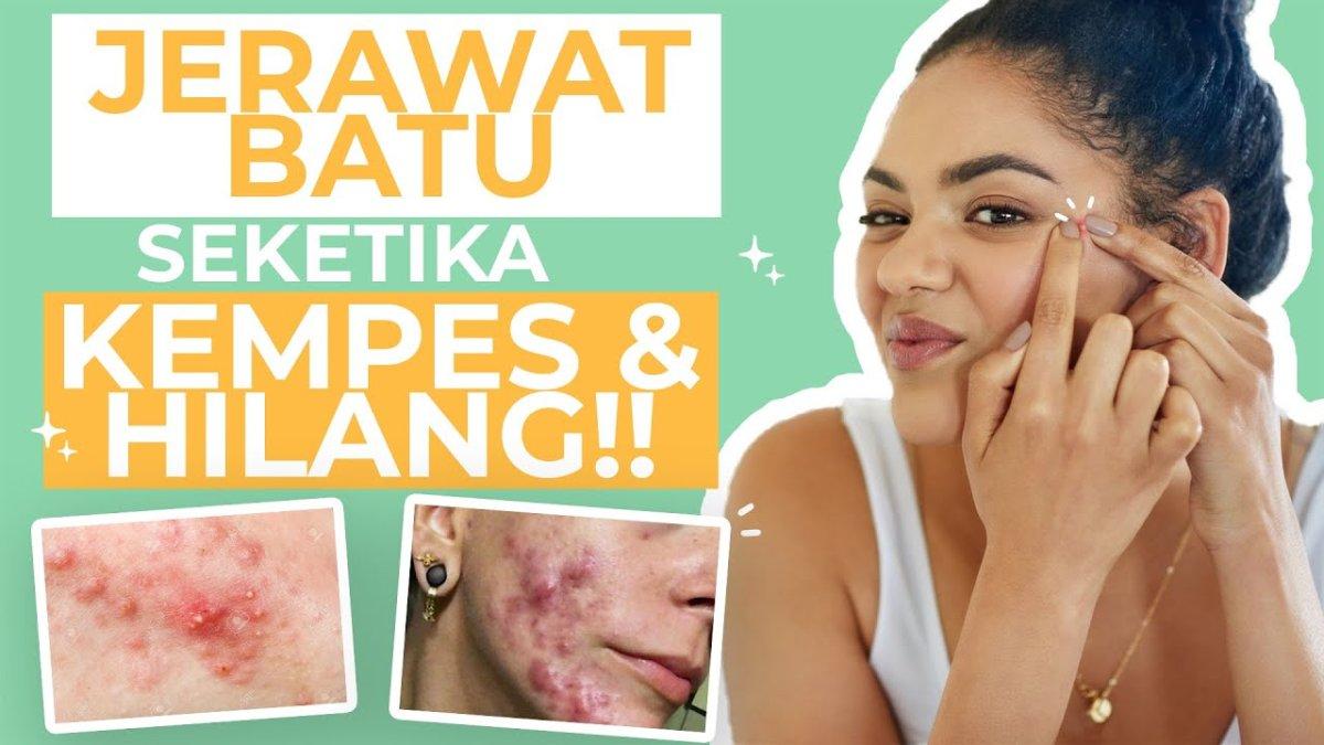 5 Cara Mudah Menyembuhkan Jerawat Batu dengan Cepat, Agar Wajah Terlihat Mulus dan Cerah ...