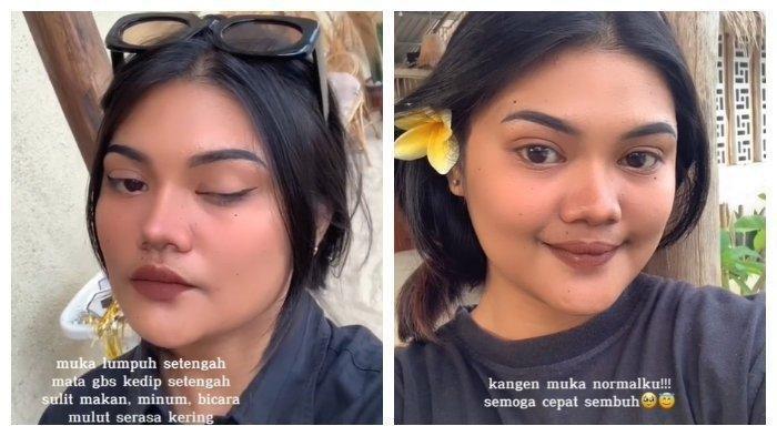 Muka Lumpuh Setengah Dikira Stroke, Gadis Ini Ternyata Idap Bell's ...