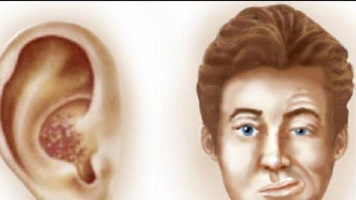 Mengenal Ramsay Hunt Syndrome, Penyakit yang Membuat Sebagian Wajah ...