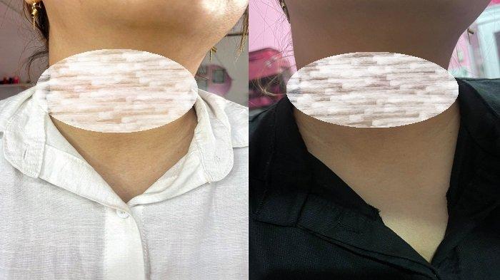 Wanita di Pomalaa Kolaka Sulawesi Tenggara Hampir Celaka Gegara Leher ...