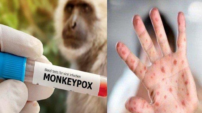 Apa Itu Kasus Monkeypox? Penularan Utama Lewat Hubungan Seksual, di ...