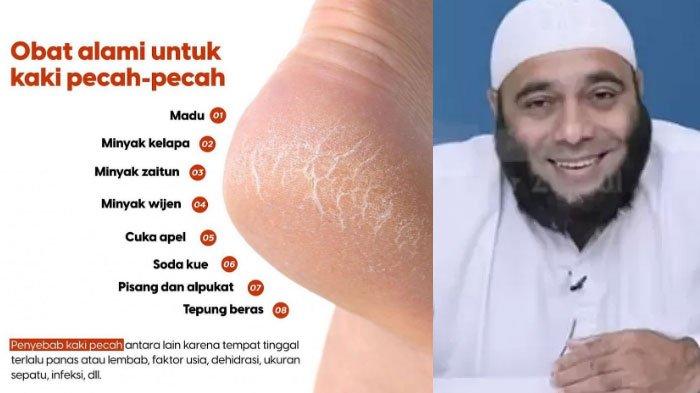 Cara Mengobati Kaki Pecah-Pecah Oleh dr Zaidul Akbar, Beri Cuka Apel ...