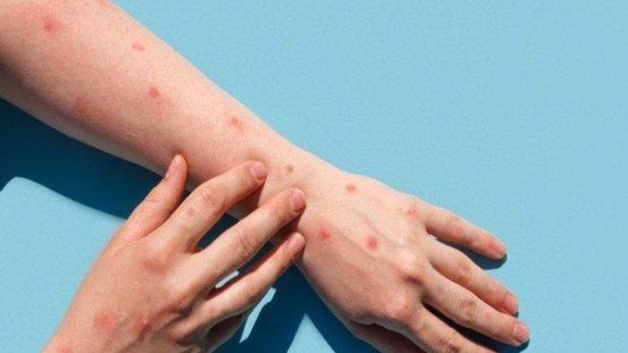 Mengenal Cacar Monyet atau Monkeypox, Inilah Gejala Awal dan Tata Cara ...