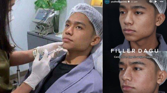 Heboh Betrand Peto Lakukan Perawatan Filler Dagu, Ingin Wajah Terlihat ...