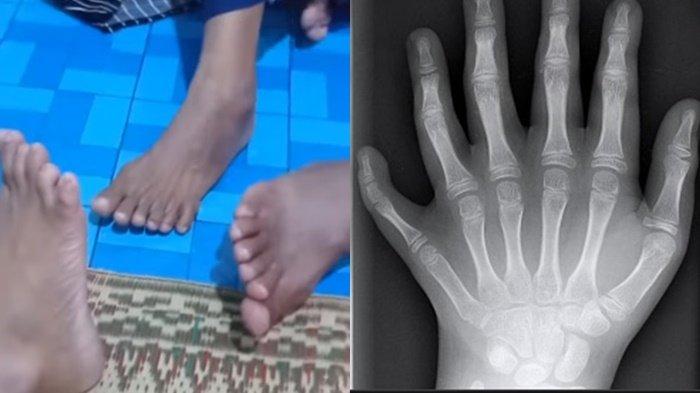 Heboh Satu Keluarga Asal Gunung Kidul Punya 6 Jari Kaki, Disebut ...