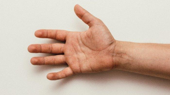 Jari Putus Bisa Disambung Kembali? Ini Penjelasan Medis dan Pertolongan ...