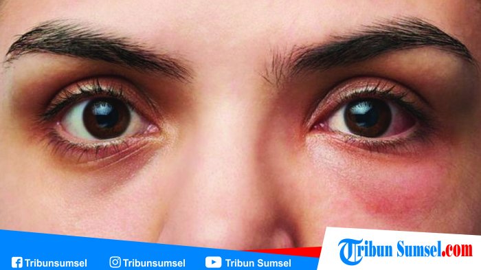 Cara Mengobati Mata Kering (Dry Eye Syndrome), Ini Gejala dan Penyebab ...