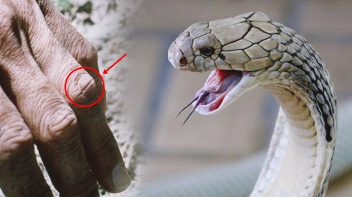 Bukan Diikat atau Disayat, Begini Cara Benar Mengangani Korban Gigitan ...