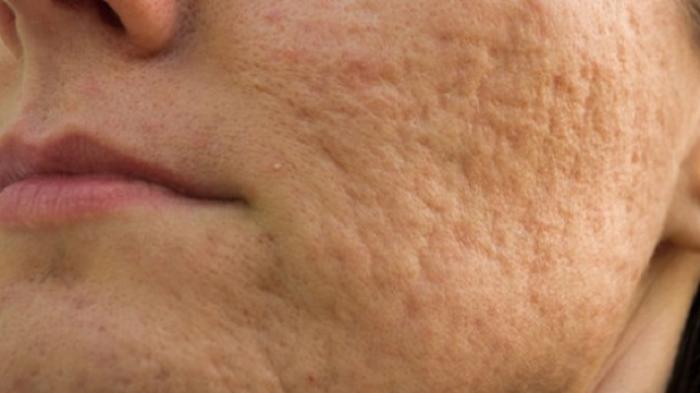 Cara Make Up Muka Berlubang | Saubhaya Makeup