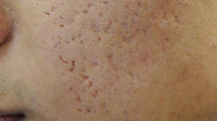 Tak Perlu Operasi Plastik, Inilah 5 Cara Mudah Hilangkan 'Bopeng' di ...