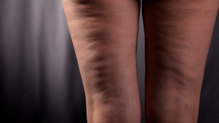 Empat Langkah Mudah Untuk Hilangkan Selulit di Tubuh - Surya.co.id