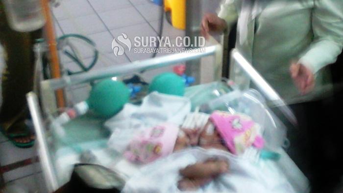 Bayi Kembar Siam Yang Baru Lahir Ini Hanya Miliki Satu Jantung - Surya.co.id