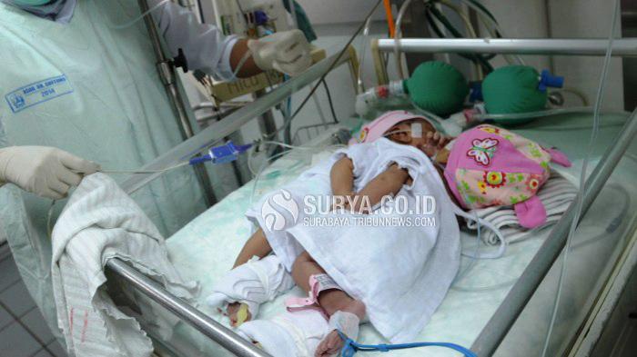 Ayah Bayi Kembar Siam Dempet Perut dan Dada Terlihat Shock - Surya.co.id