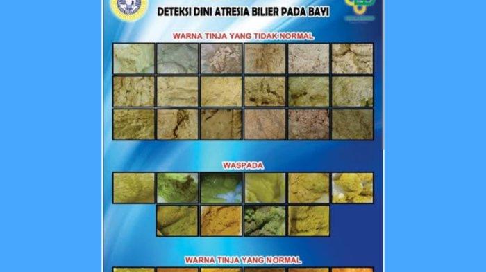 Terlambat Bisa Fatal. Waspada Kuning Dan Tinja Pucat Pada Bayi Lebih ...