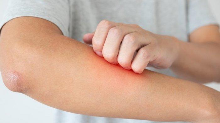 LIFEPACK: Mengenal Obat Cortidex Untuk Anti Alegri, Simak Manfaat ...