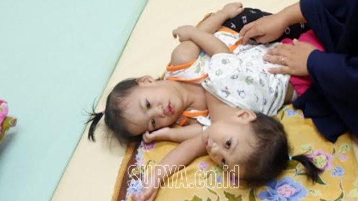 BREAKING NEWS - Bayi Kembar Siam Aqila-Azila Jalani Operasi Pemisahan Hari Ini, Ditangani 70 ...