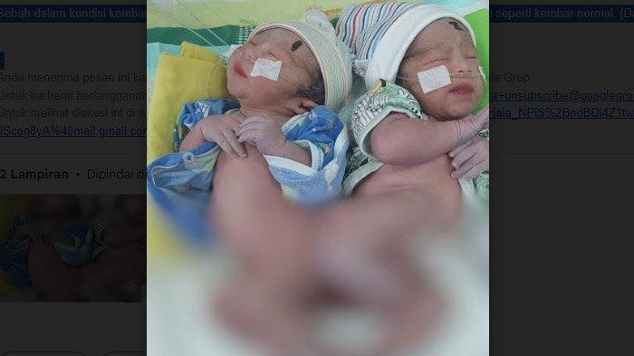 Kasus Bayi Kembar Siam di Tulungagung Akibat Ovum Gagal Pisah Sempurna, Sulit Dideteksi di ...