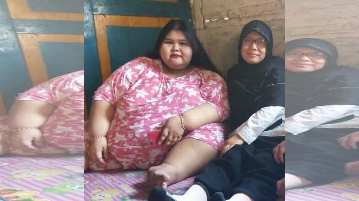 Kondisi Terakhir Remaja 15 Tahun asal Lamongan yang Alami Obesitas. Dua ...