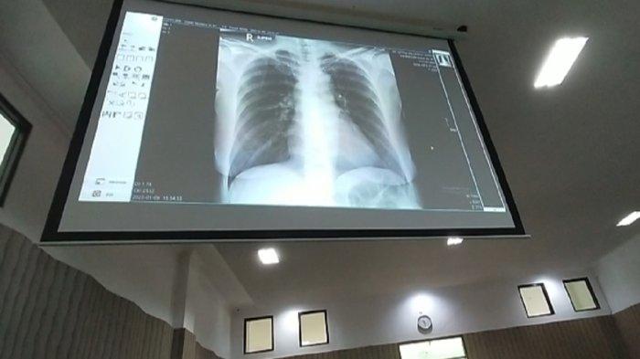 Penampakan Tulang Rusuk Venna Melinda yang Retak Ditampilkan di ...