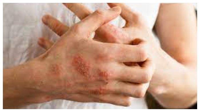 Kasus Penyakit Kusta di Kota Batu, 4 Orang Penderitanya Meninggal Dunia ...