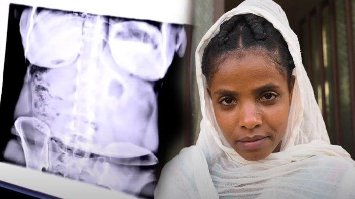 Kondisi Usus Wanita Tidak Makan Dan Minum Selama 16 Tahun Dokter Syok Menemukan Fakta Tidak