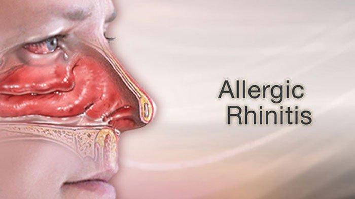 Mengenal Rhinitis Alergika, Meski Bukan Penyakit Fatal Tapi Mempengaruhi Aktifitas - Suryamalang.com