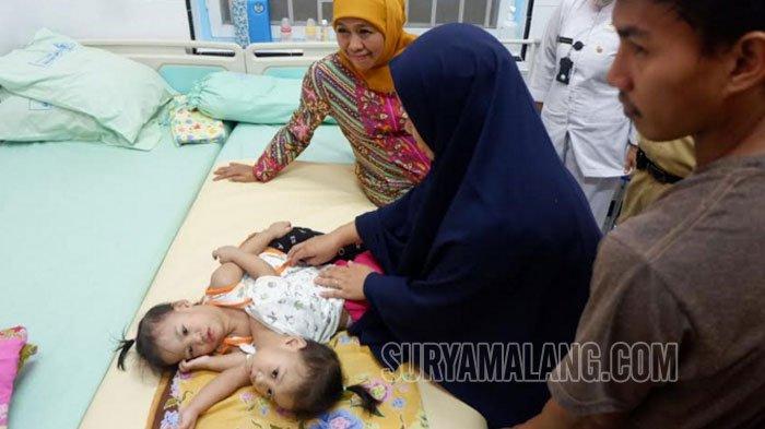 Update Kondisi Kembar Siam asal Kendari, Akila Dewi Syabila dan Azila Dewi Sabrina, di Surabaya ...