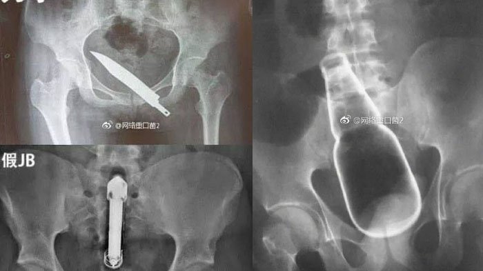 Perhatikan Deretan Foto Hasil Rontgen Ini, Kok Bisa Benda Tak Lazim Ini ...