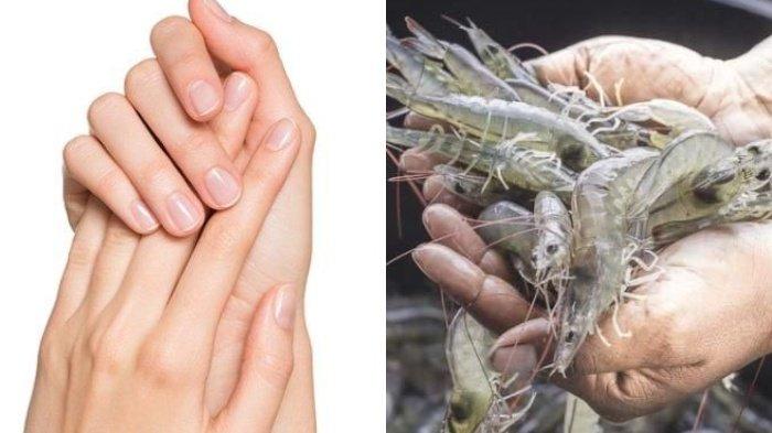 Tertusuk Udang Berujung Diamputasi, Jari Pria Berubah Menghitam ...