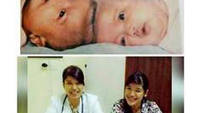 Kabar Yuliana & Yuliani Kembar Siam Pertama yang Berhasil Dioperasi di Indonesia, Sukses Jadi ...