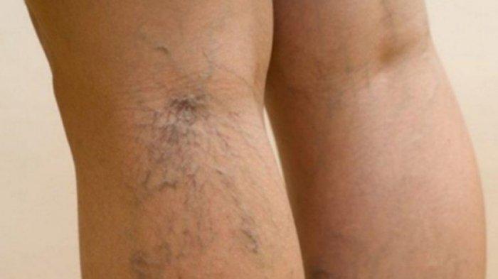 Varises Bukan Sekedar Estetika saja, Tapi bisa Sebabkan Bengkak dan ...