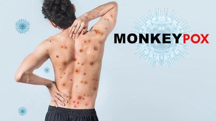 Mengenal Penyakit Zoonosis Cacar Monyet atau Monkeypox, Ini Gejala dan ...