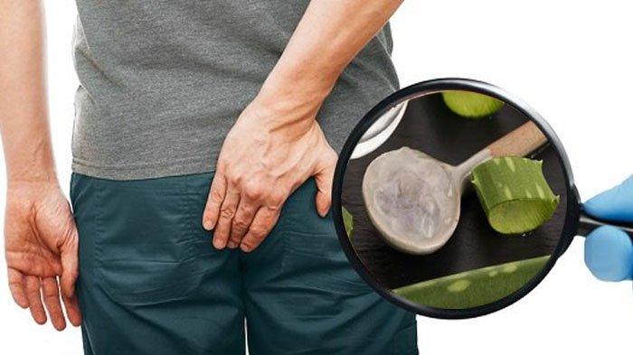 6 Obat Herbal untuk Terapi Wasir atau Ambeien, Mudah Didapatkan ...