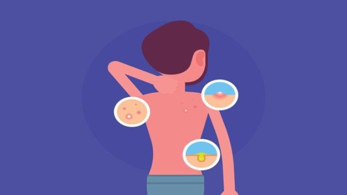 Sering Bisulan? Ini Dia Penyebab Bisul dan Cara Pencegahannya ...