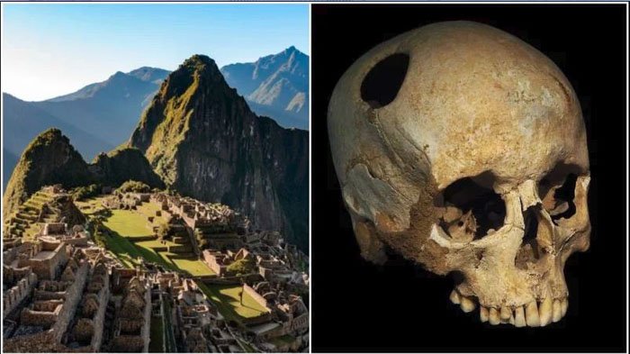 Trepanasi, Teknik Pengeboran Kepala yang Dilakukan Suku Inca untuk ...