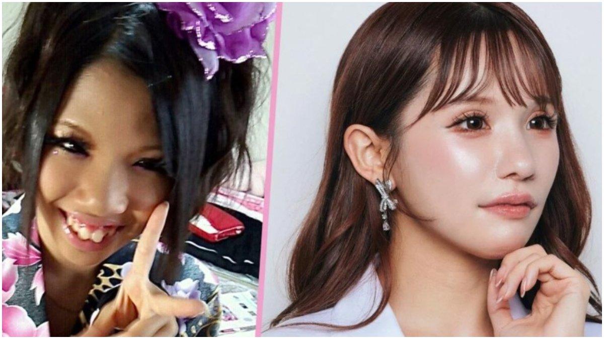 Trauma Dihina, Wanita Ini Pilih Operasi Plastik hingga 20 Kali, Nasib ...