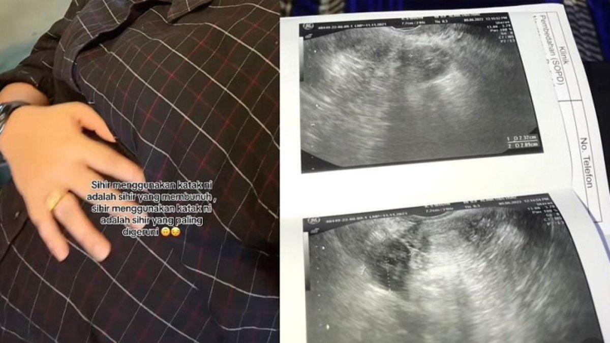 Perut Membesar dan Mengeras, Gadis Heran Dokter Tidak Temukan Masalah ...