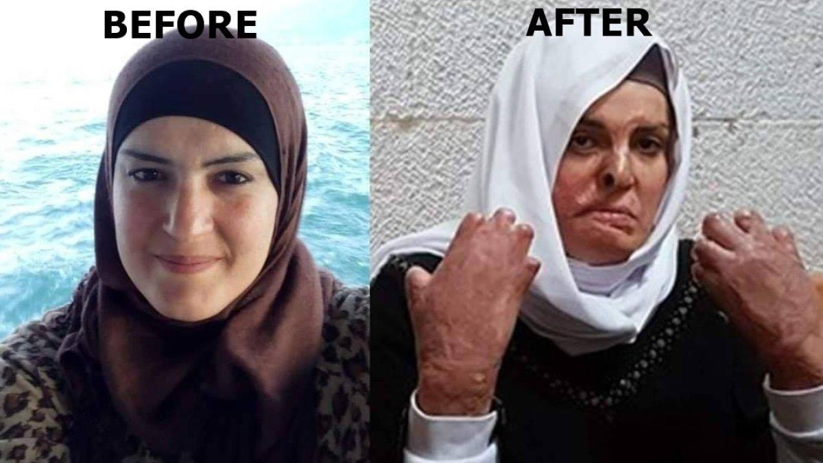 SOSOK Israa Jaabis Wanita Palestina Ditahan Israel, Takut Lihat Cermin Setelah Wajah Berubah ...