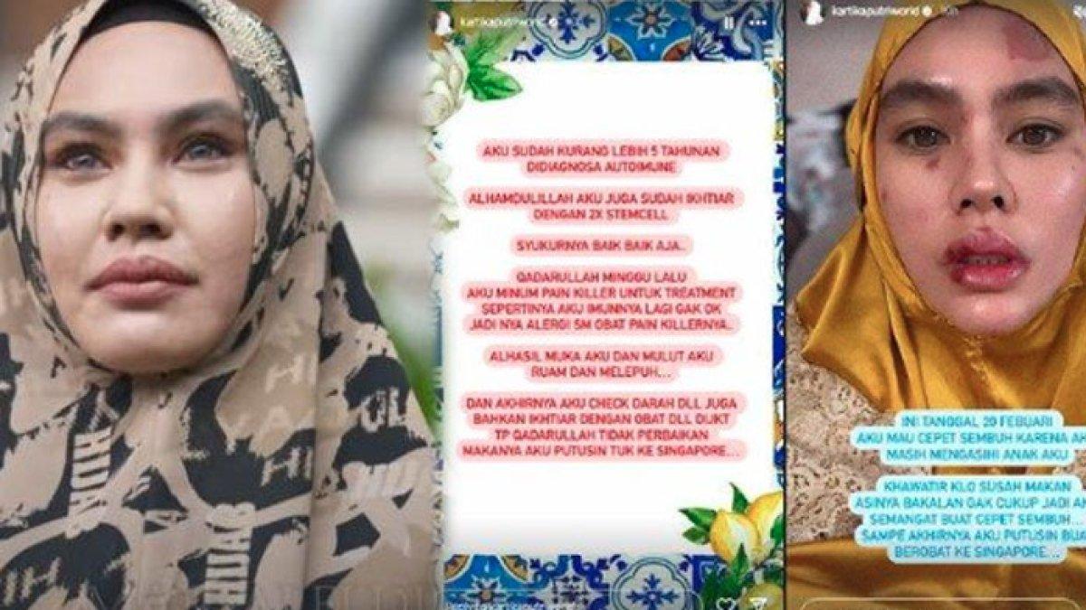 Mulut Melepuh hingga Ruam di Muka, Kartika Putri Idap Autoimun, Sudah 5 ...