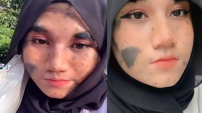 Viral Gadis Cantik Punya Banyak 'Tompel' di Wajah, Ungkap Rahasia Tetap ...