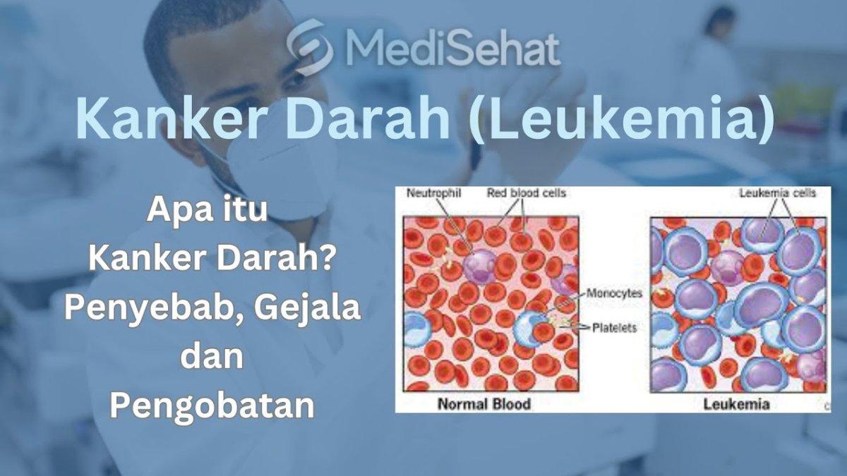 7 Cara Mengobati Kanker Darah Dengan Kemoterapi, Terapi Radiasi ...