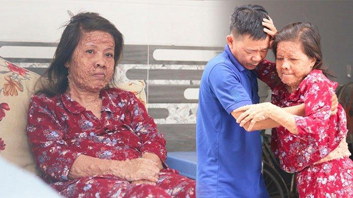 SEKUJUR Tubuh Istri Penuh Bintil, Suami Tulus Mencinta: Selalu Jadi ...