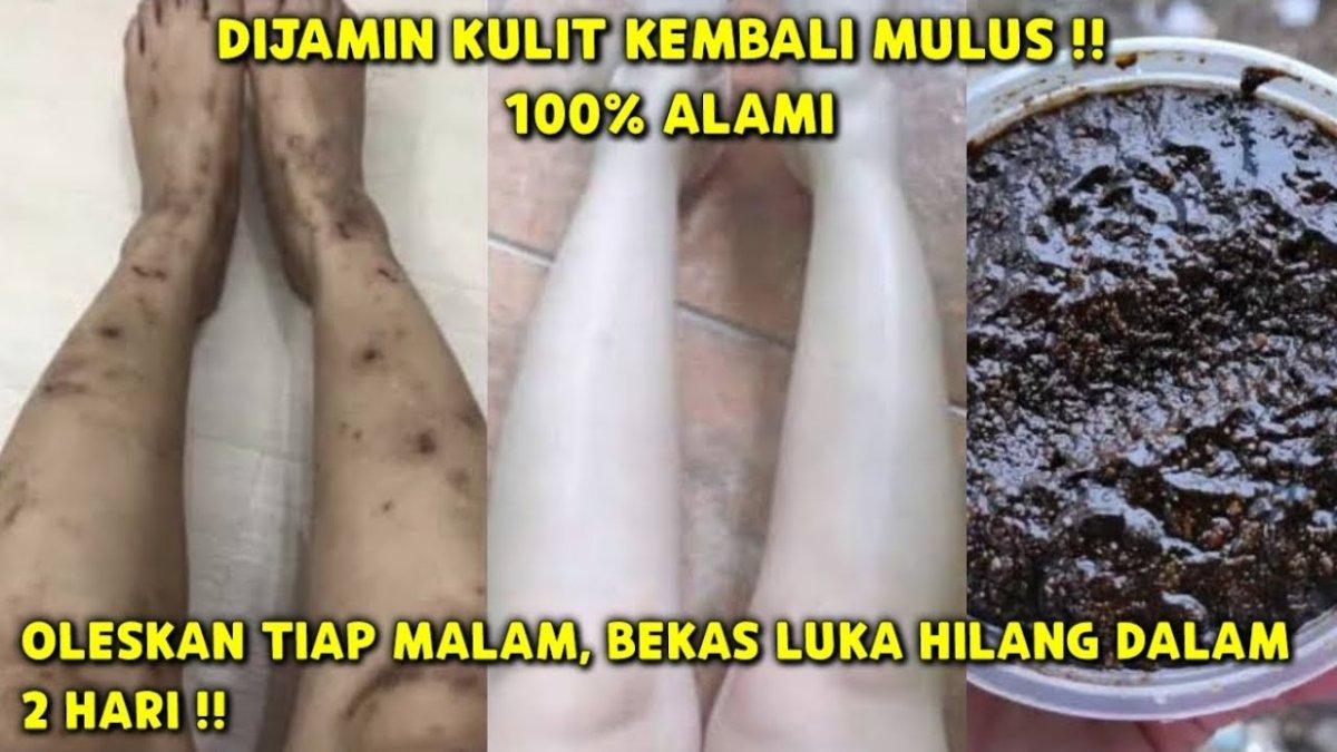 5 Cara Mengobati Koreng Dengan Bahan Alami Madu, Lidah Buaya, Minyak ...
