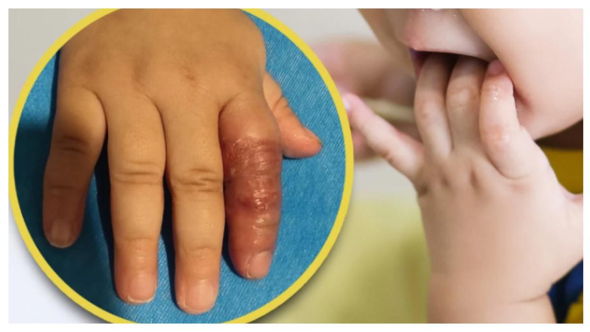 Bungkus Jari Bayi untuk Cegah Mengisap, Seorang Ibu Hampir Sebabkan ...