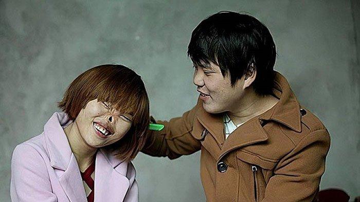 Cinta Tanpa Pandang Fisik Gadis Tanpa Hidung Dilamar Pria Idaman