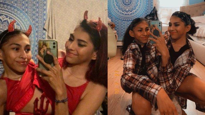 Terlahir Dempet Sejak Lahir, Wanita Kembar Ini Ungkap Cara Pacaran ...