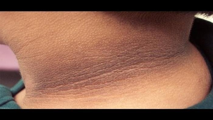 Atasi Leher Hitam yang Menggangu Penampilan, Coba Oleskan Cuka Apel ...